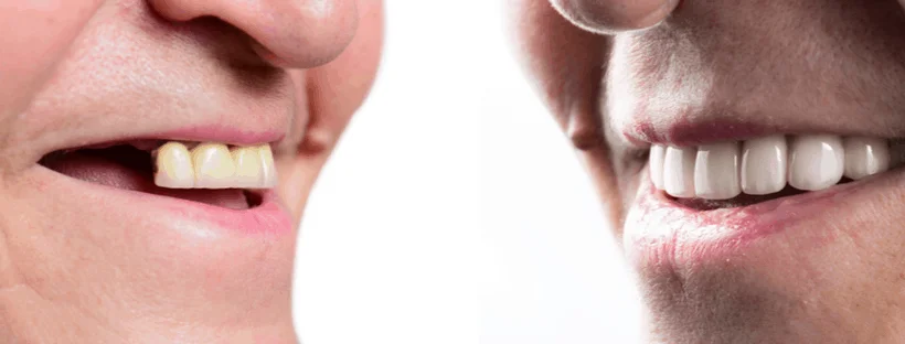 Permanent tooth replacement (dental implants for missing or broken teeth)